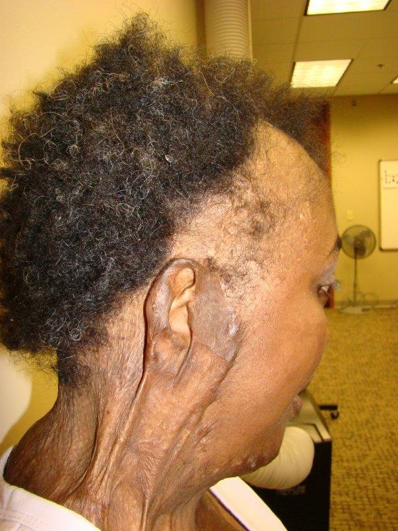 Victim 3 Burn Injuries - ABC Columbia