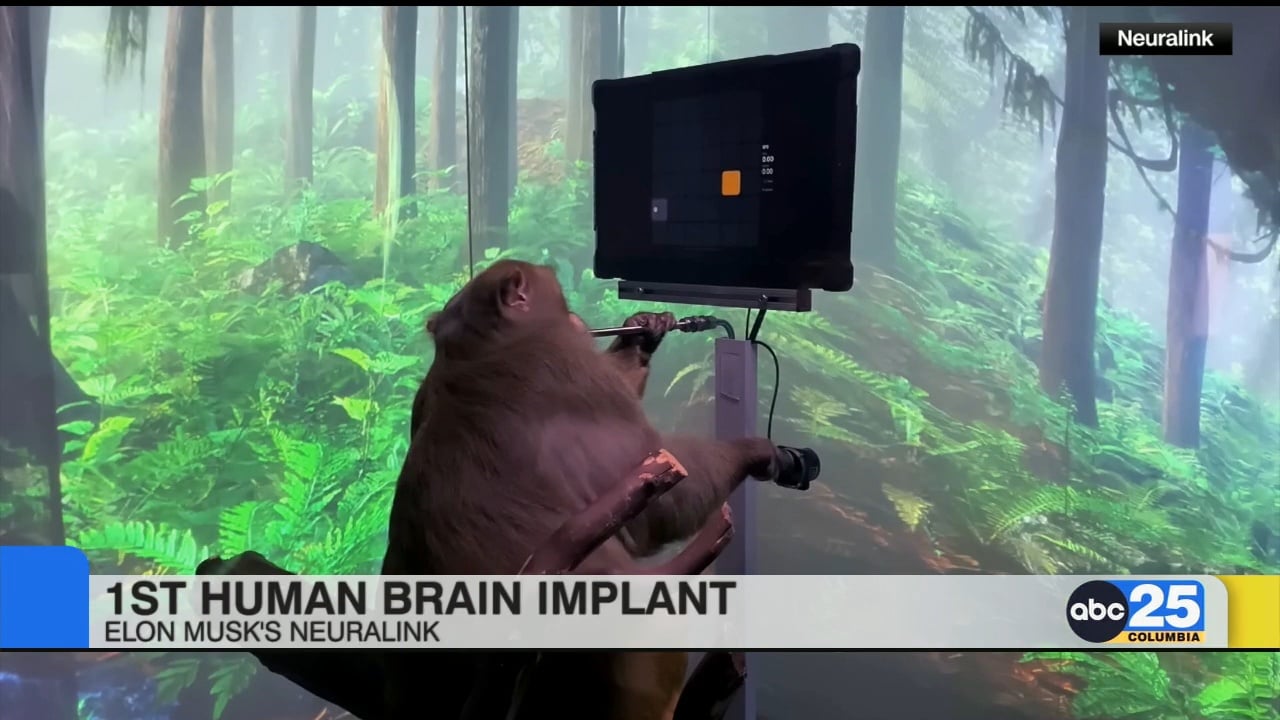 1st human brain implant - ABC Columbia