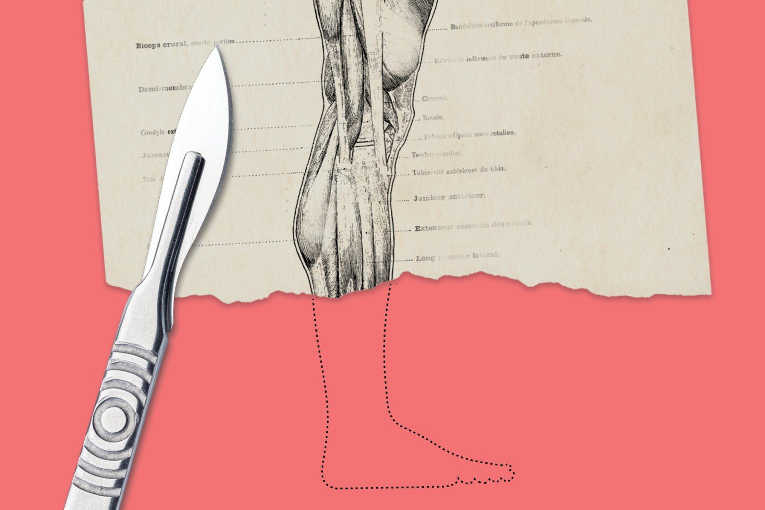 One-Fourth of Diabetes Patients Lose Limbs. These Doctors Are Trying to ...