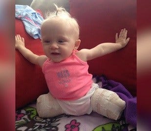Baby with rare condition doing well after amputation