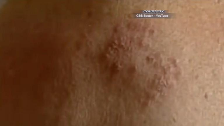 Shingles Awareness Week begins Feb. 24, here's what to know - WBBJ TV