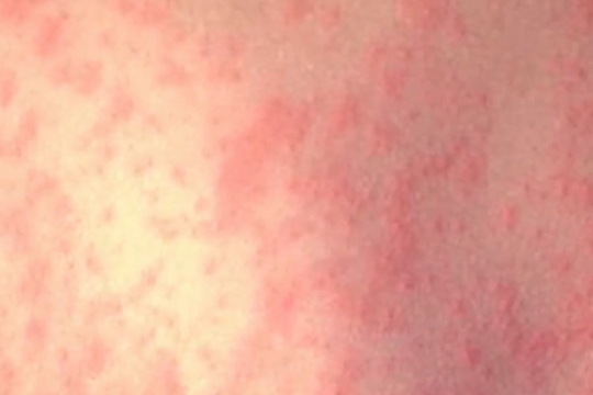 Measles - Rash - WCCB Charlotte