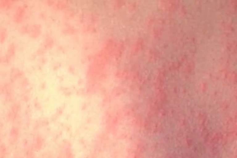 Measles - Rash - WCCB Charlotte
