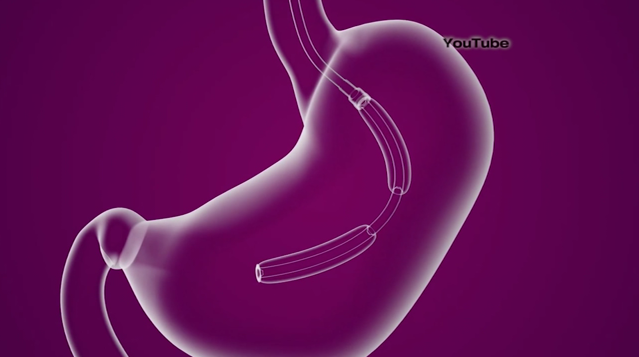 Delaware physicians perform first Reshape Dual Balloon System procedure ... Delaware physicians perform first Reshape Dual Balloon System procedure ...