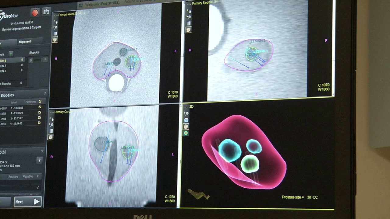 Atlantic General Hospital adds innovative prostate cancer screening ...