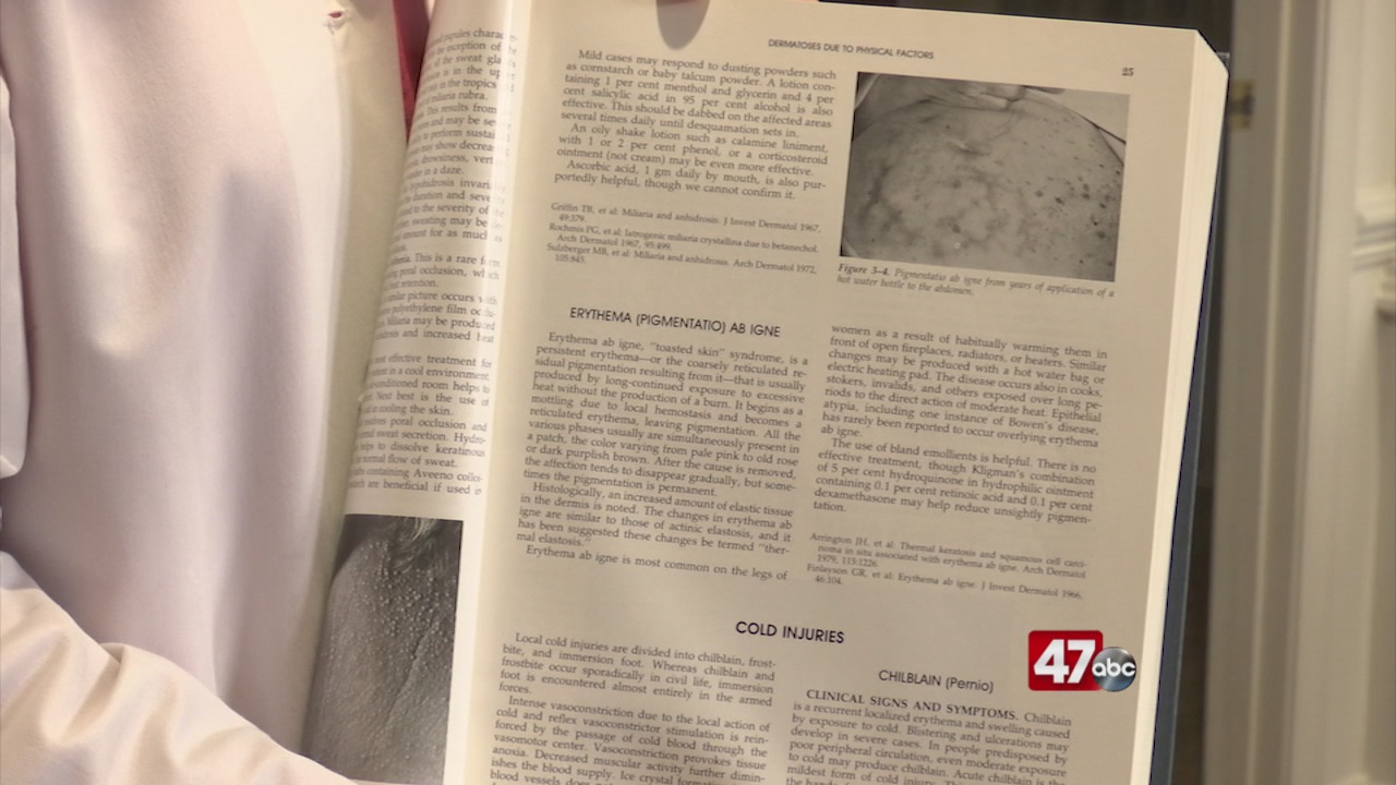 Toasted Skin Syndrome; a rash you should know about - 47abc