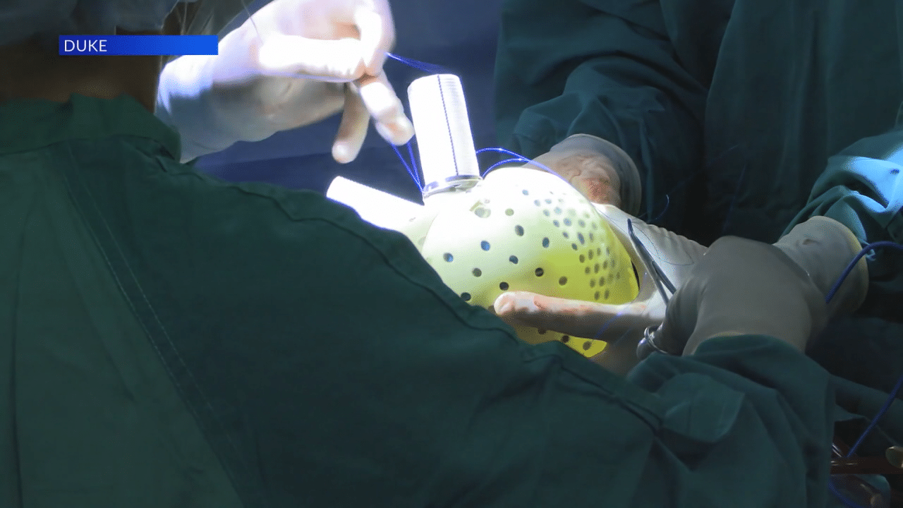 Duke 1st in the country to implant new artificial heart - WWAYTV3